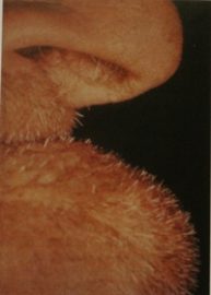 Facial Collapse and How to Fix It | Top Dentist Reviews