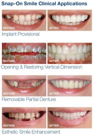 Top 5 Best Snap-on Veneers - Brands, Features, Cost | Top Dentist Reviews